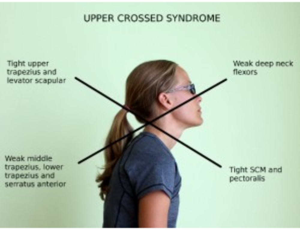 Lower Crossed Syndrome - My Talk With Dr. Khris Ramdeen | Move Empower ...